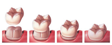 RESTORATIVE SERVICES | Quality Dental Care