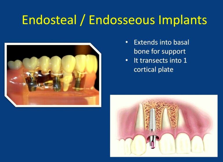 Types of Dental Implants | Quality Dental Care | Adelaide, South Australia